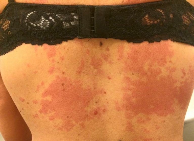 Mum reveals how booze can trigger a burning red rash which coats her ...