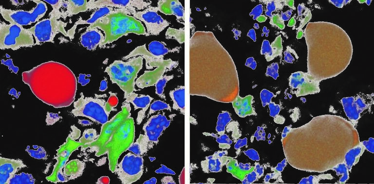 Breast cancer cells can be forced to become ‘harmless’ fat cells, say ...