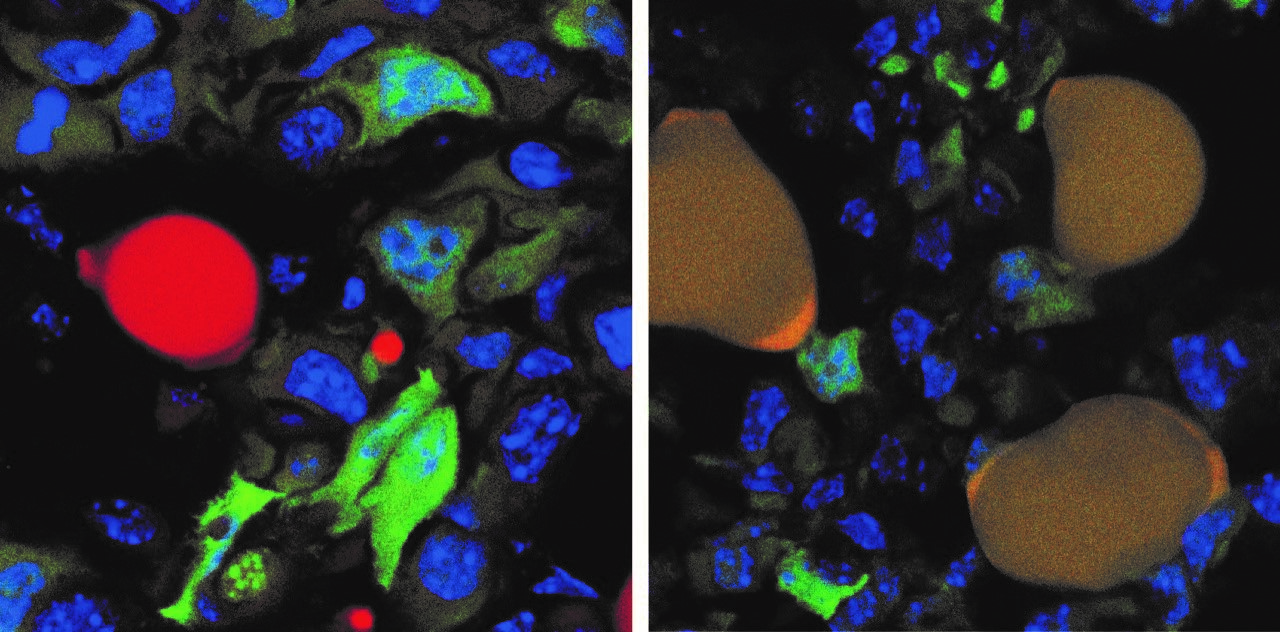 Breast cancer cells can be forced to become ‘harmless’ fat cells, say ...