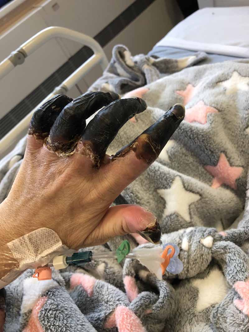 NHS nurse who lost limbs to sepsis dubs stumps “beautiful” as ...