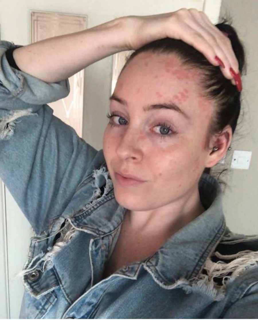 Woman with psoriasis so severe that it even affected her eyelids ...