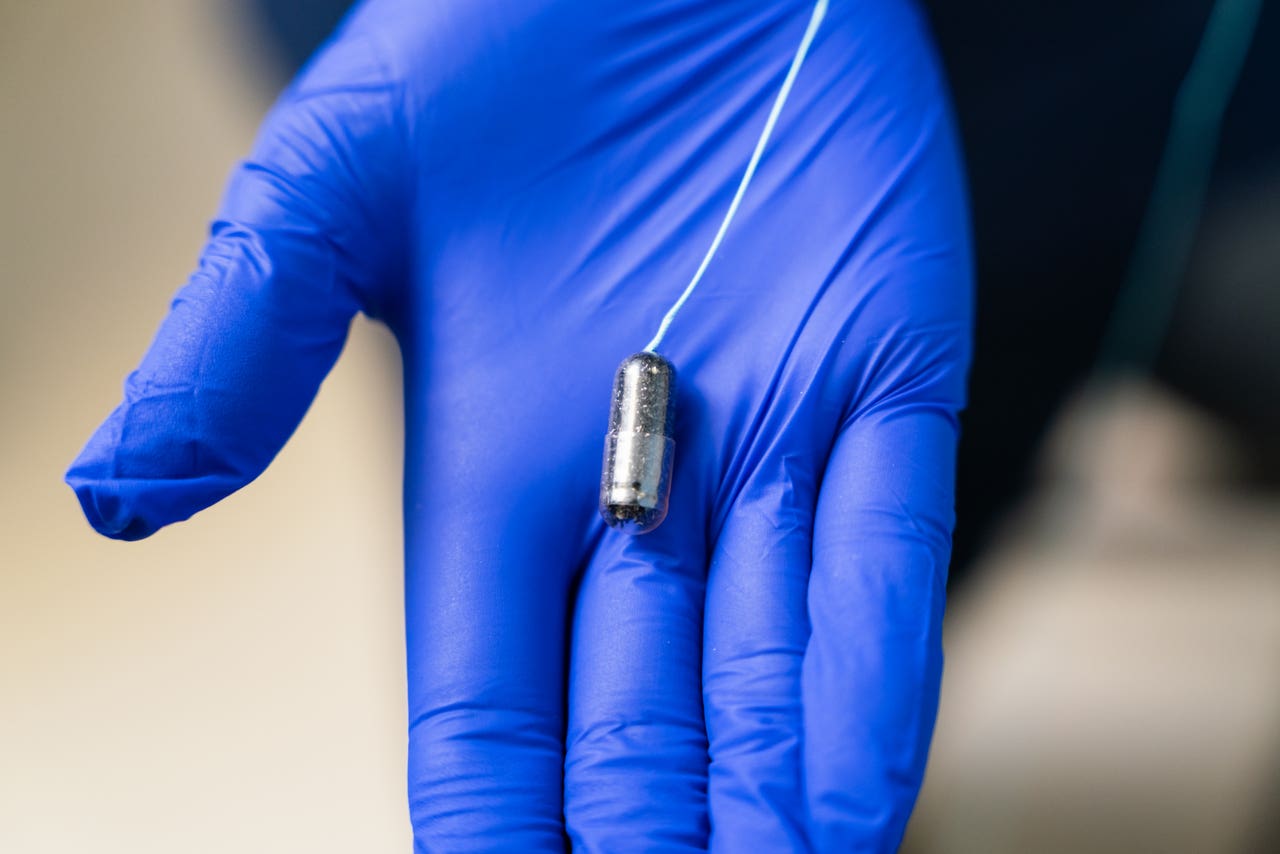 ‘Sponge on string’ alternative to endoscopy rolled out for cancer ...