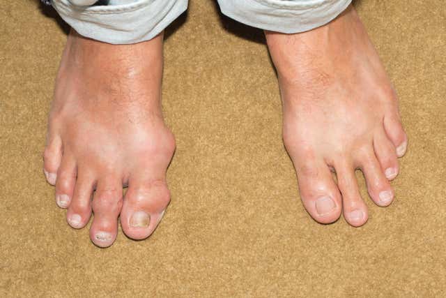 What is gout – and what are the early warning signs to look out for ...