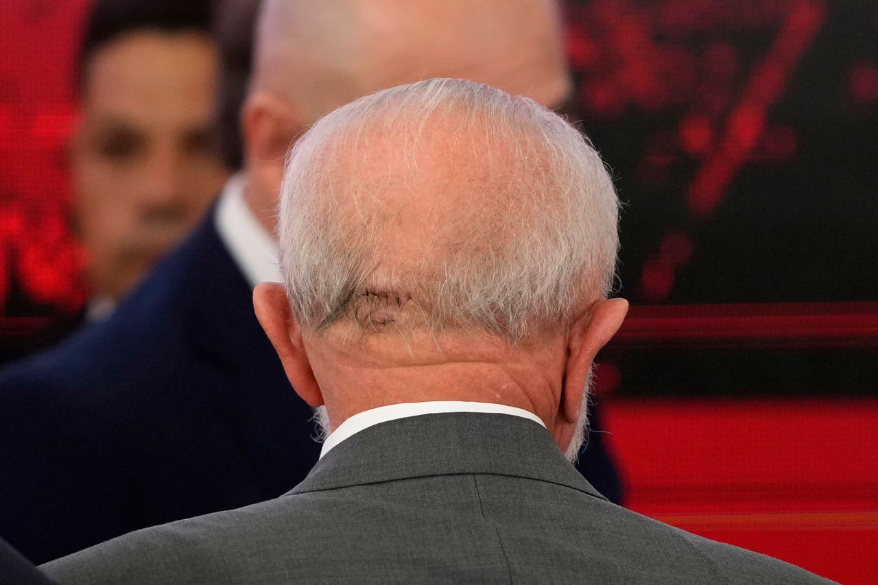 Brazil’s president undergoes second procedure to stop brain bleed